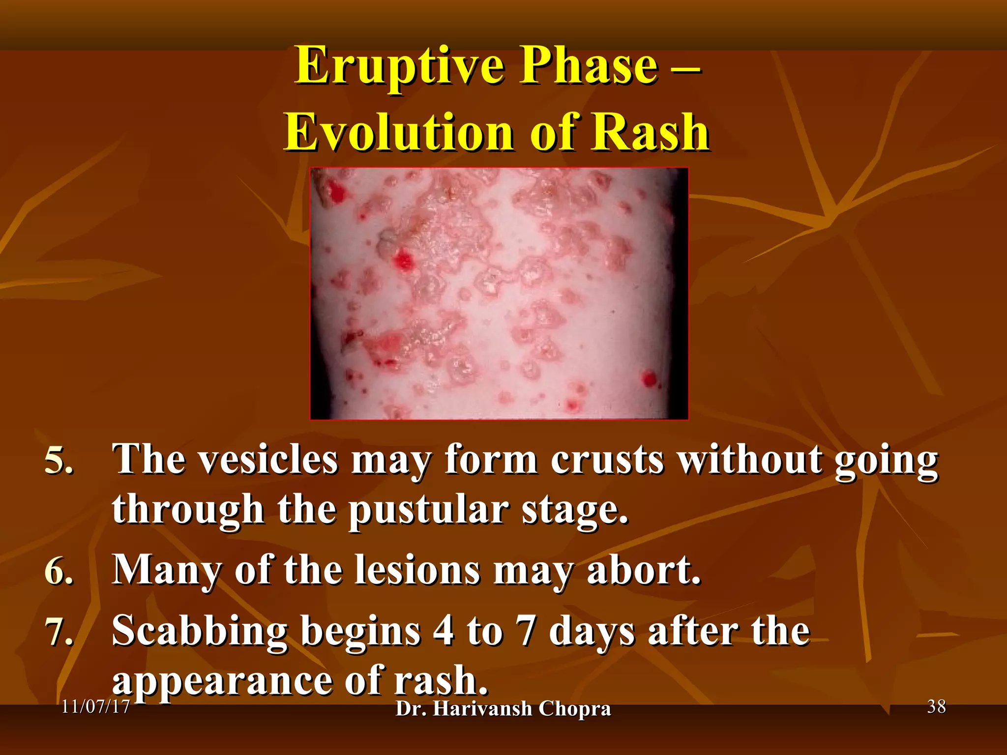 Chickenpox (varicella) dr harivansh chopra | PPT