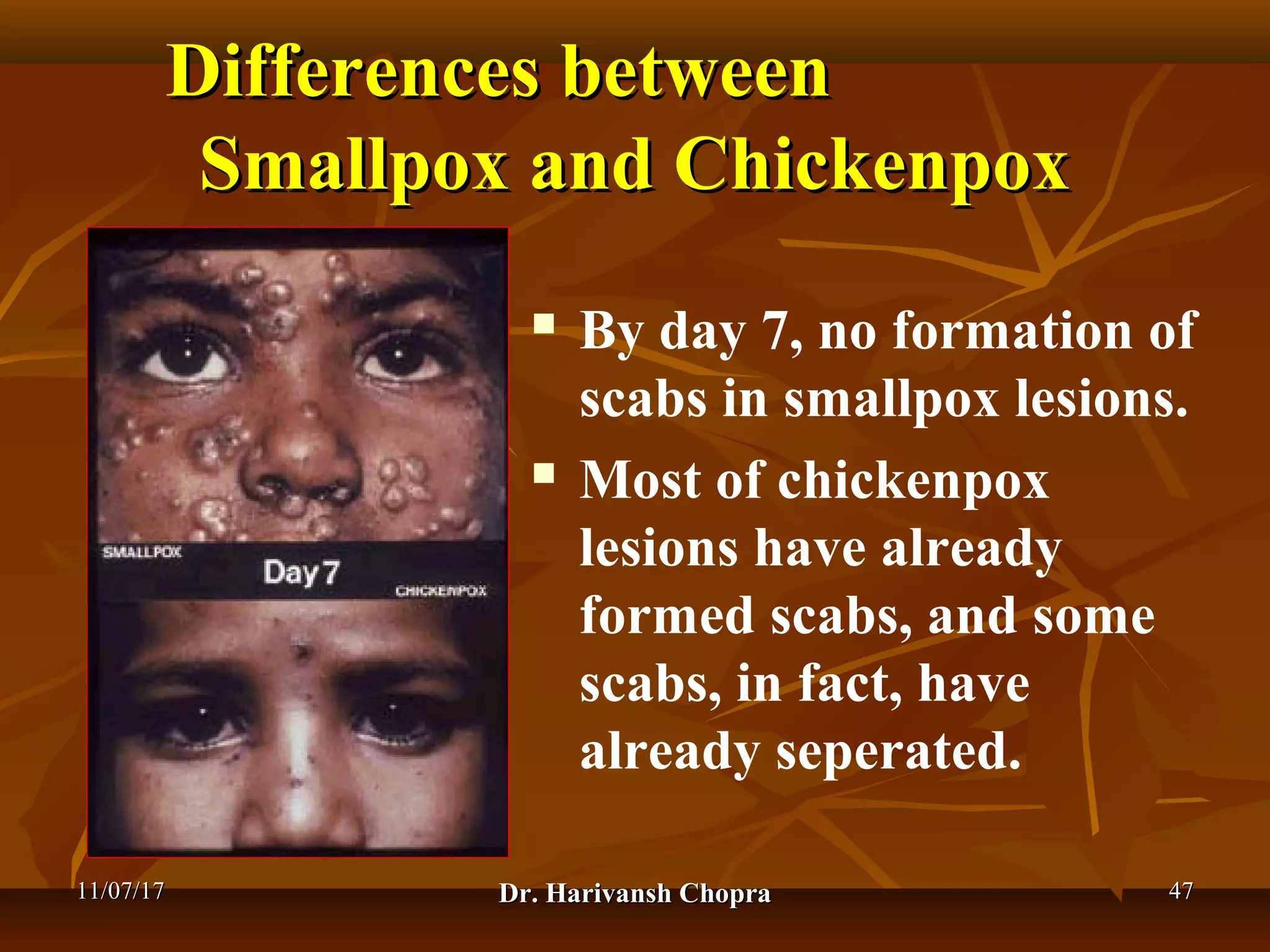 Chickenpox (varicella) dr harivansh chopra | PPT