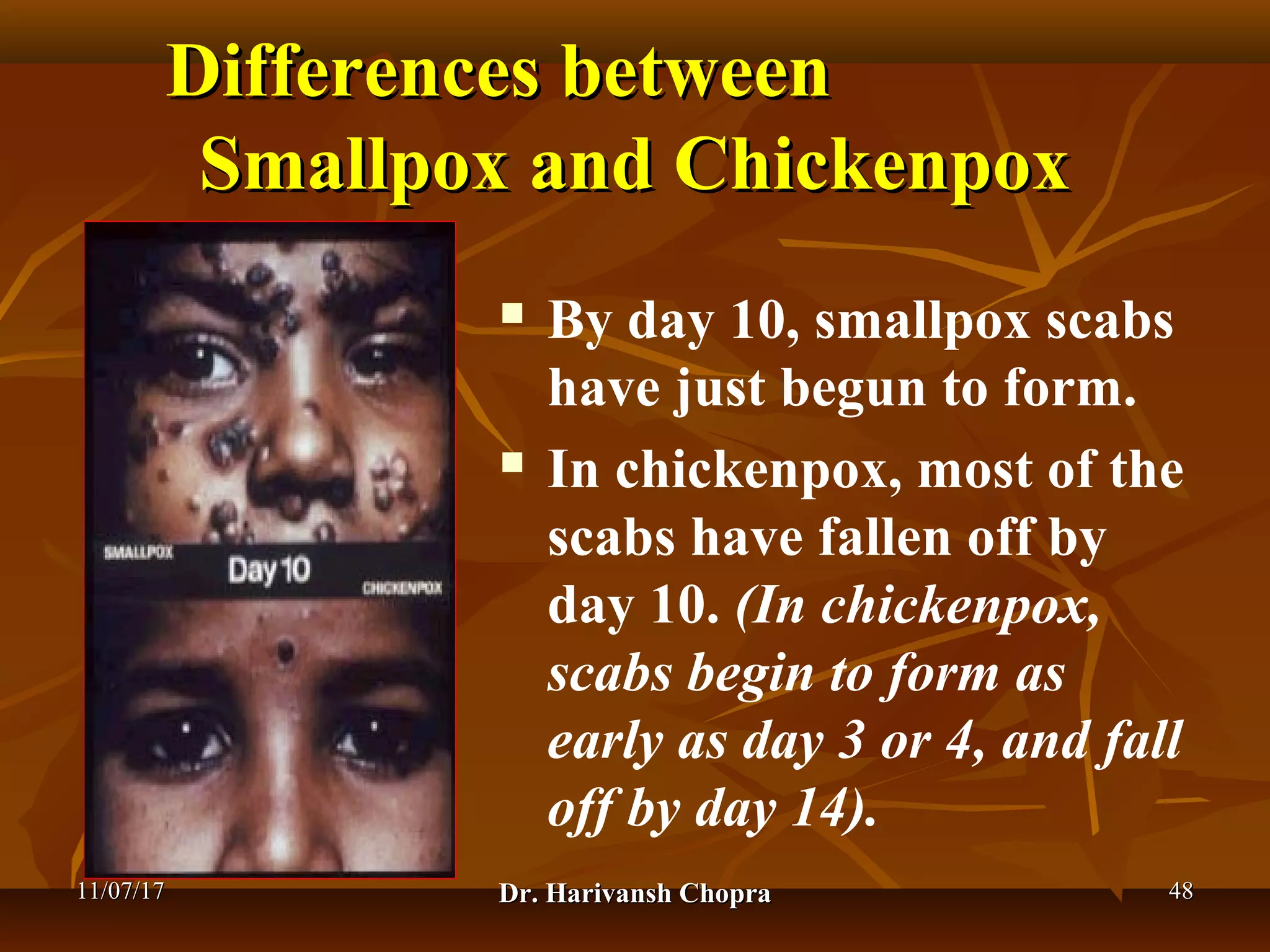 Chickenpox (varicella) dr harivansh chopra | PPT