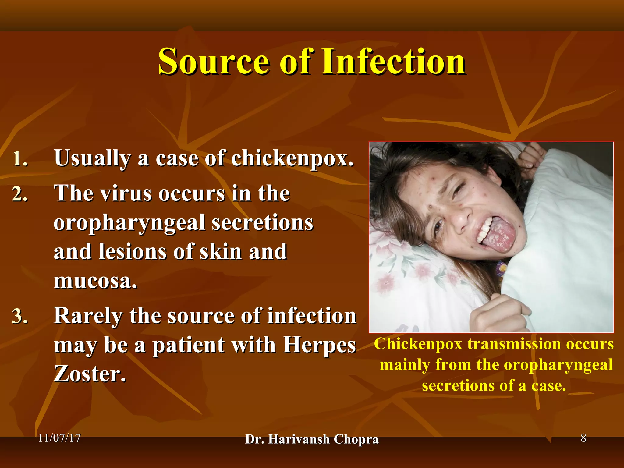 Chickenpox (varicella) dr harivansh chopra | PPT