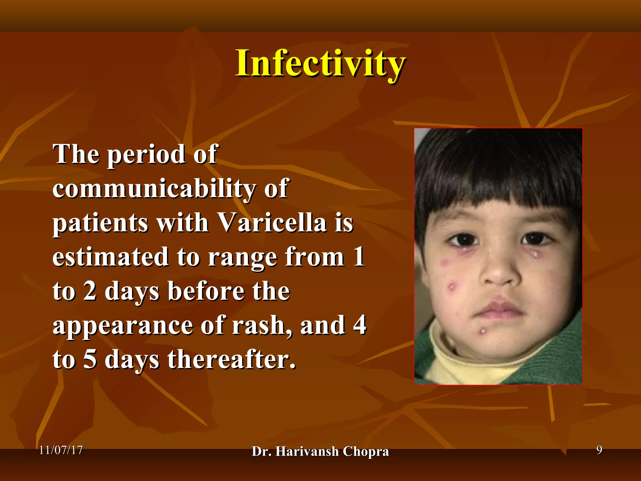 Chickenpox (varicella) dr harivansh chopra | PPT