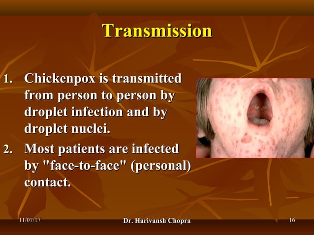 Chickenpox (varicella) dr harivansh chopra | PPT