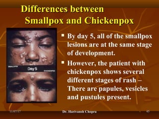 Chickenpox (varicella) dr harivansh chopra | PPT