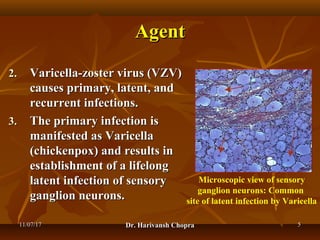Chickenpox (varicella) dr harivansh chopra | PPT