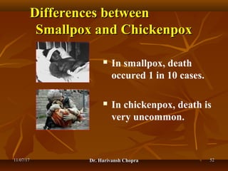 Chickenpox (varicella) dr harivansh chopra | PPT