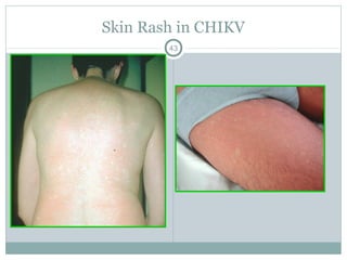 Chikungunya Face Rash
