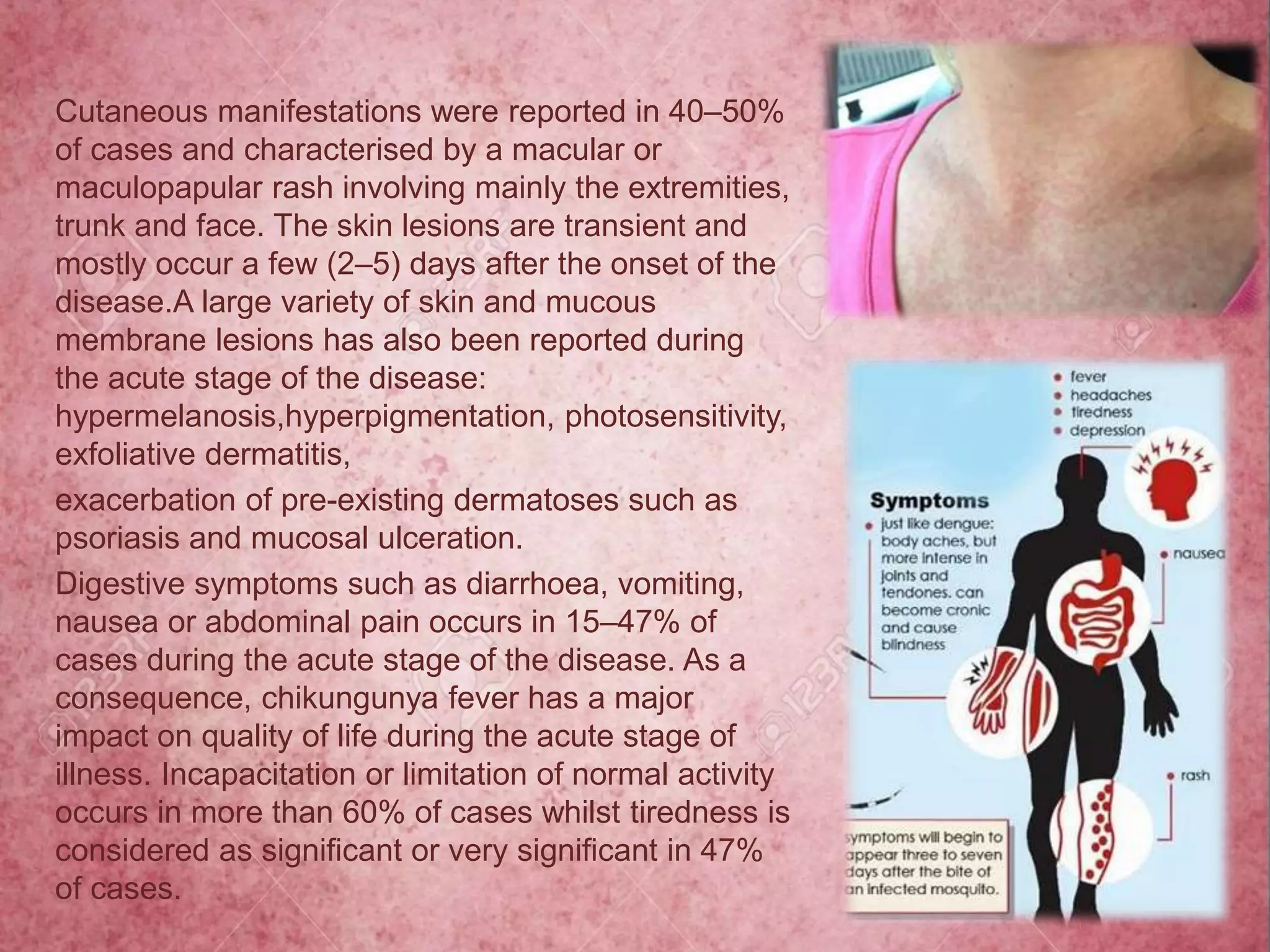 Chikungunya fever | PPTX
