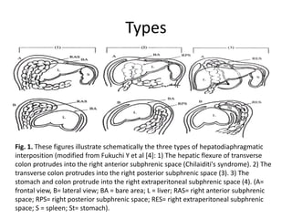 Chiladiti syndrome | PPTX