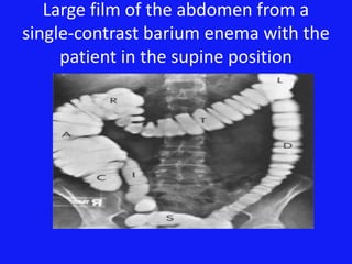 Chiladiti syndrome | PPT