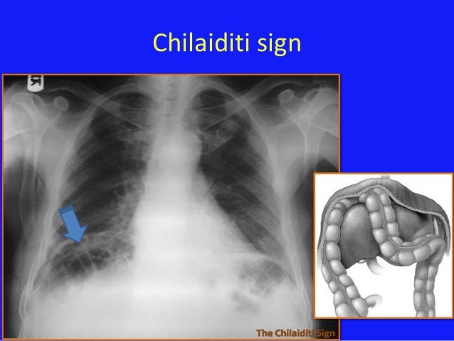 Chiladiti syndrome