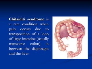 Chilaiditi's syndrome | PPT