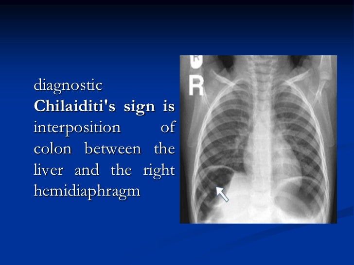 Chilaiditi's syndrome