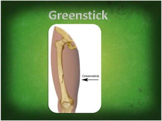 Child abuse and greenstick fracture .7man
