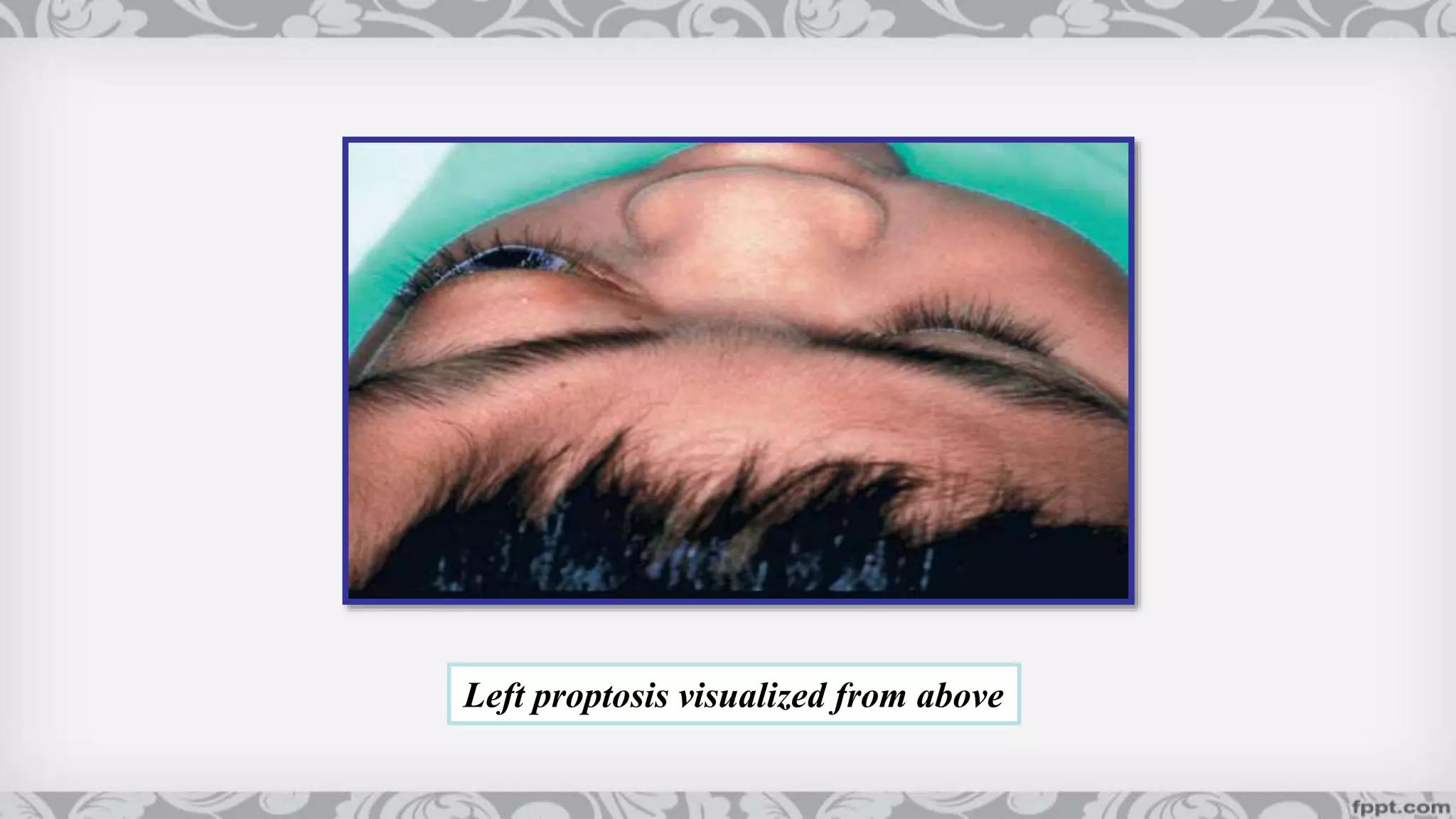 Child Proptosis | PPTX