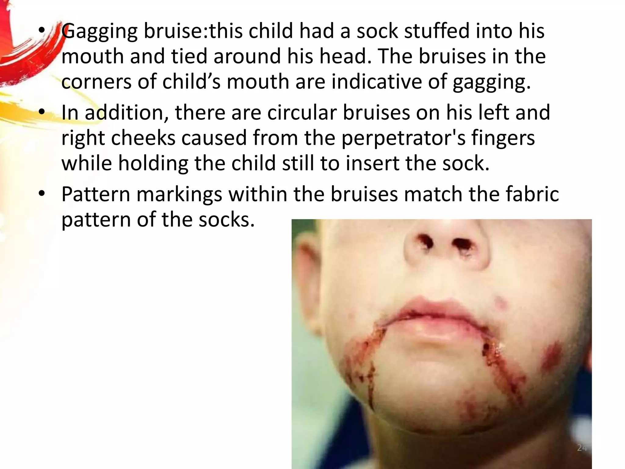 Child abuse and neglect in forensic odontologist's aspect | PPTX