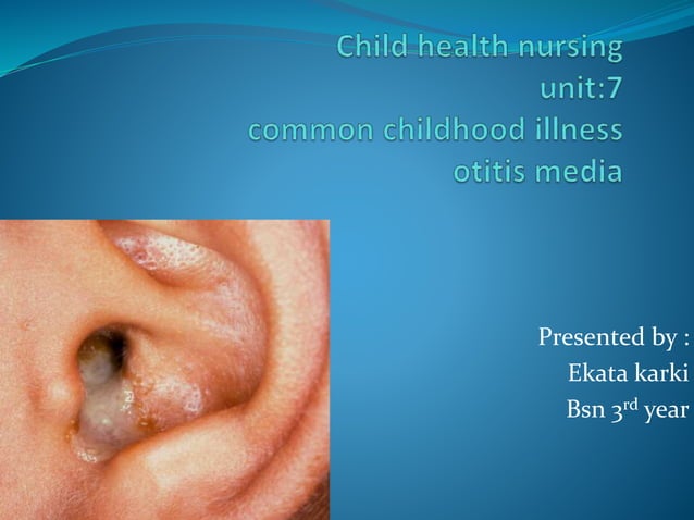 otitis media | PPTX
