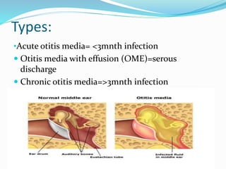 otitis media | PPTX