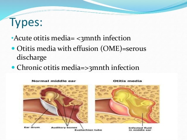 otitis media