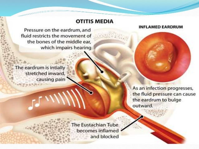 otitis media