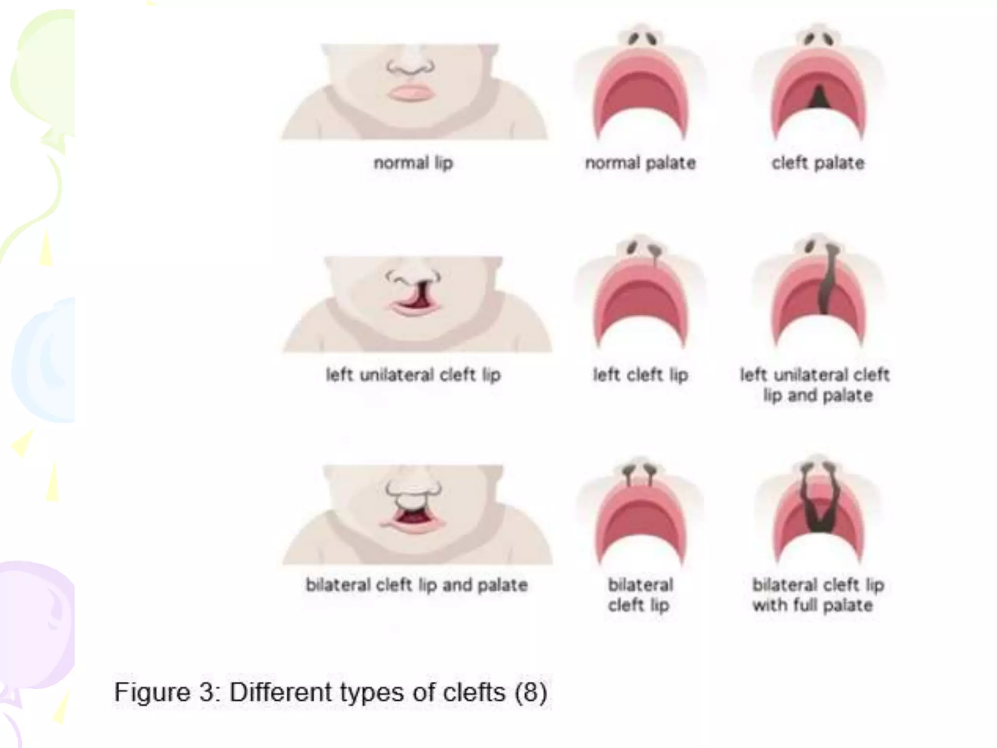 Tracheo Esophahgeal Fistula,Cleft lip and Palate | PPTX