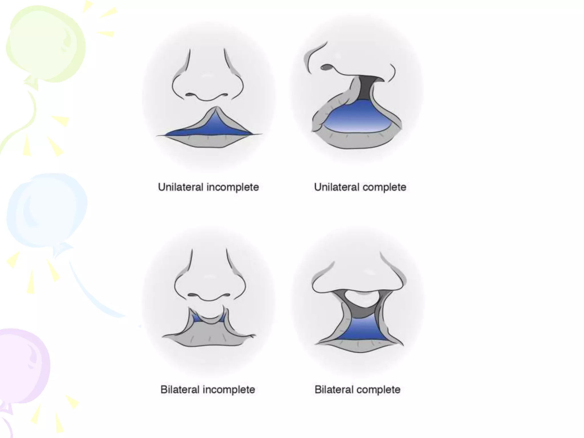 Tracheo Esophahgeal Fistula,Cleft lip and Palate | PPTX
