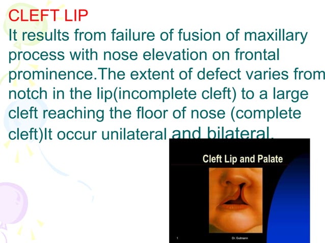 Tracheo Esophahgeal Fistula,Cleft lip and Palate | PPTX