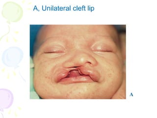 Tracheo Esophahgeal Fistula,Cleft lip and Palate | PPTX