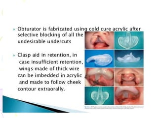 Tracheo Esophahgeal Fistula,Cleft lip and Palate | PPTX