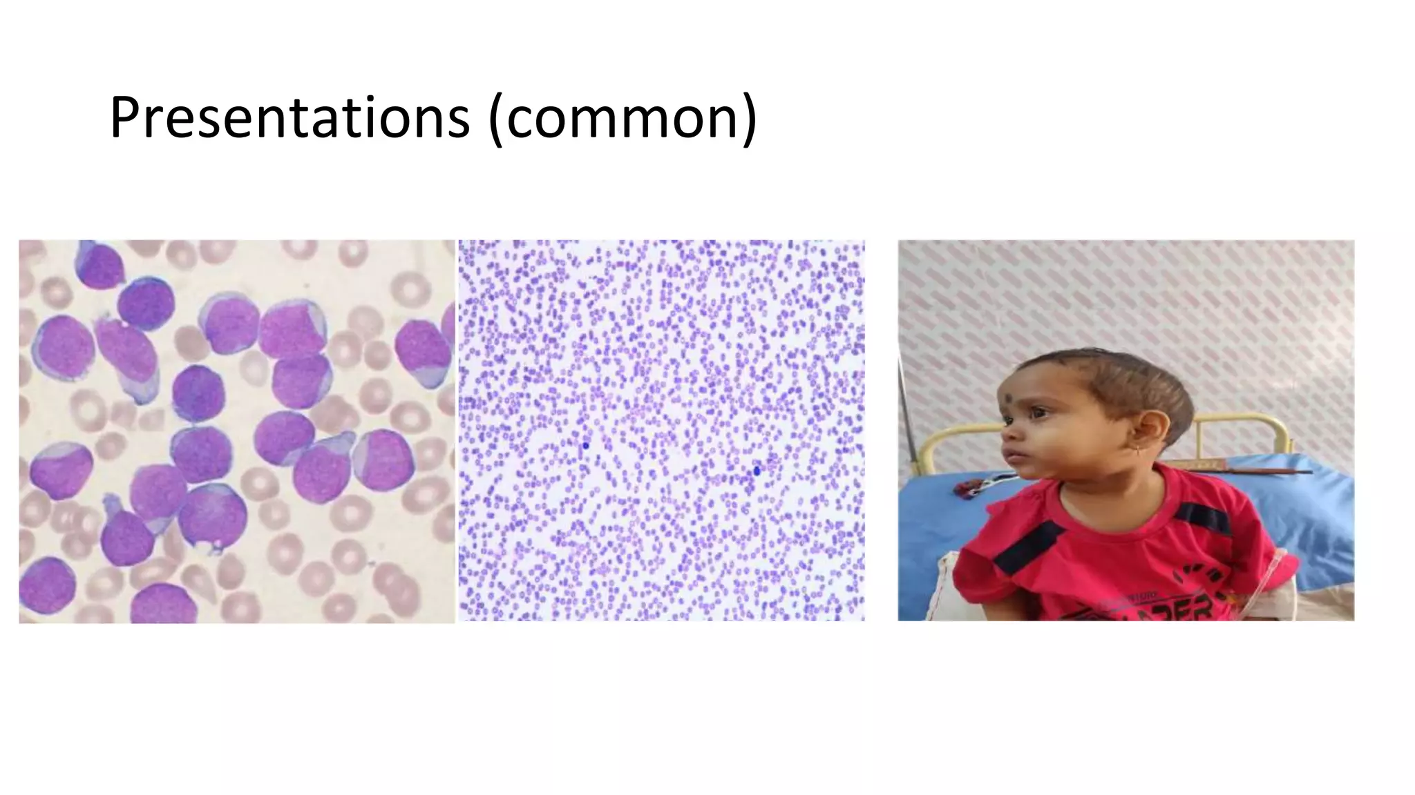 Childhood Acute Leukemia.pptx