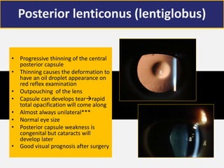 Childhood cataracts | PPTX