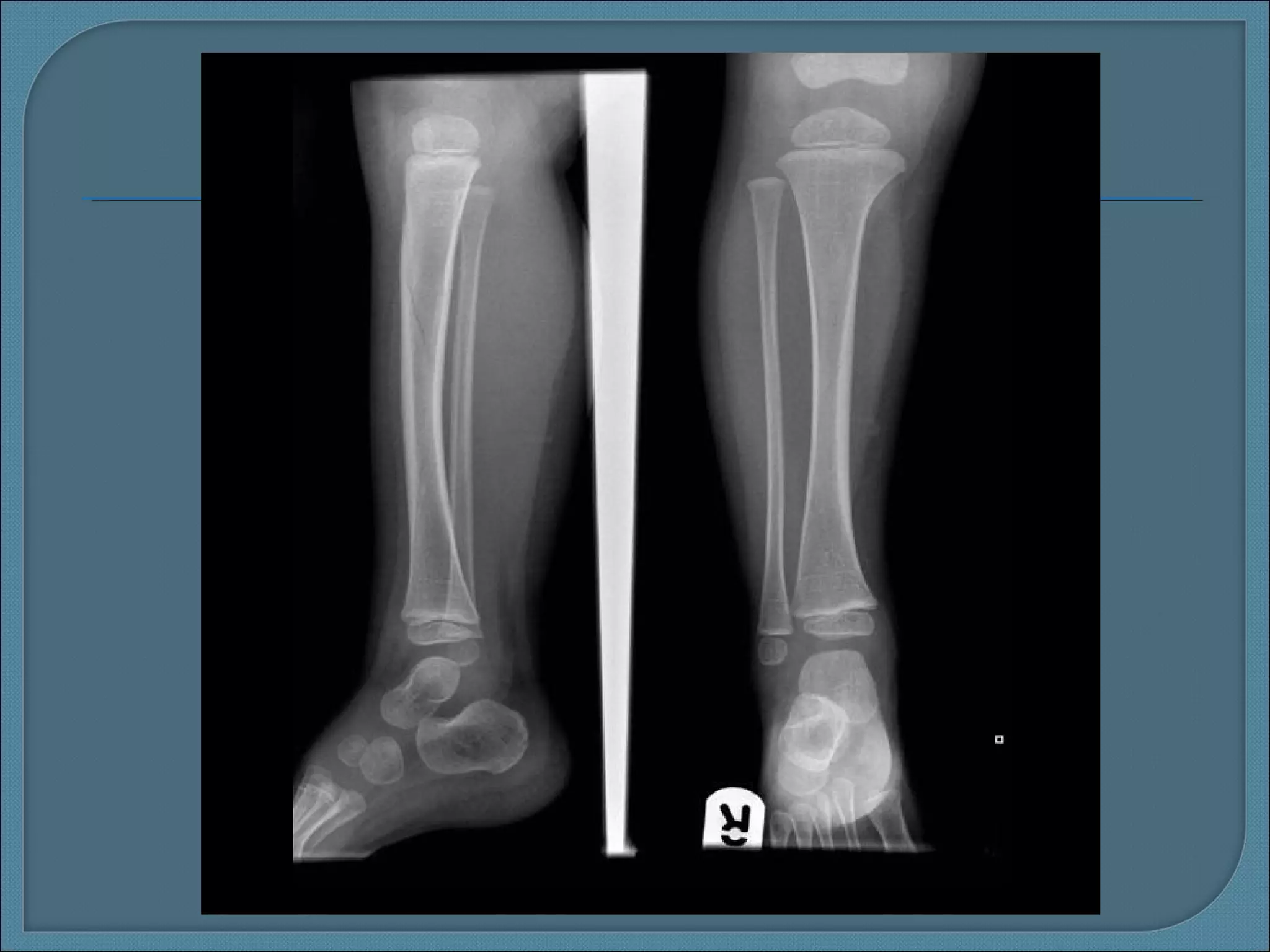 Childhood fractures | PPT