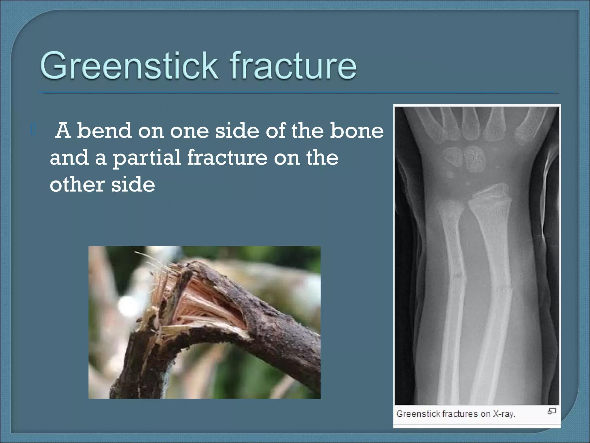 Childhood fractures | PPT