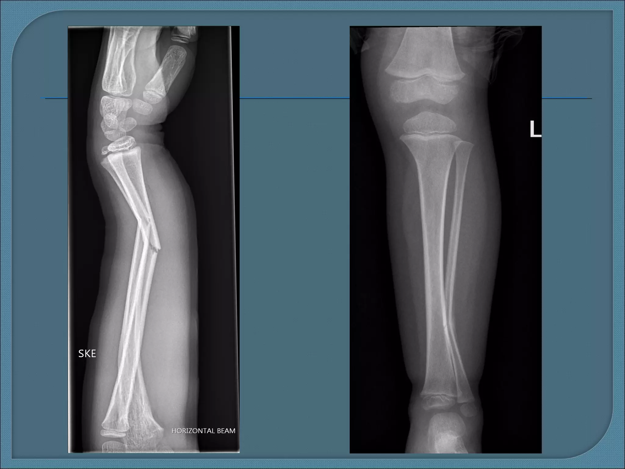 Childhood fractures | PPT