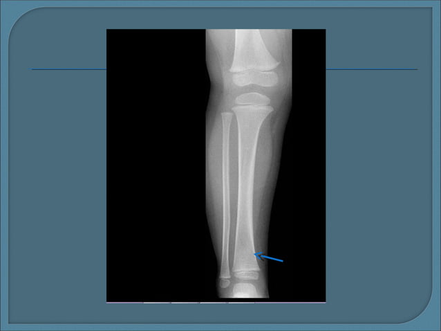 Childhood fractures | PPT
