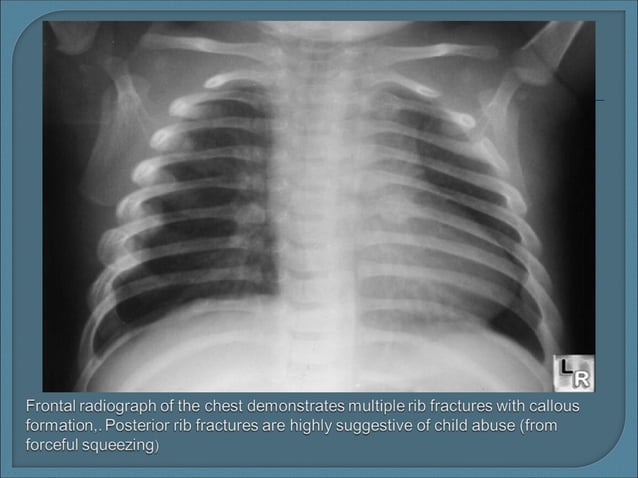 Childhood fractures | PPT