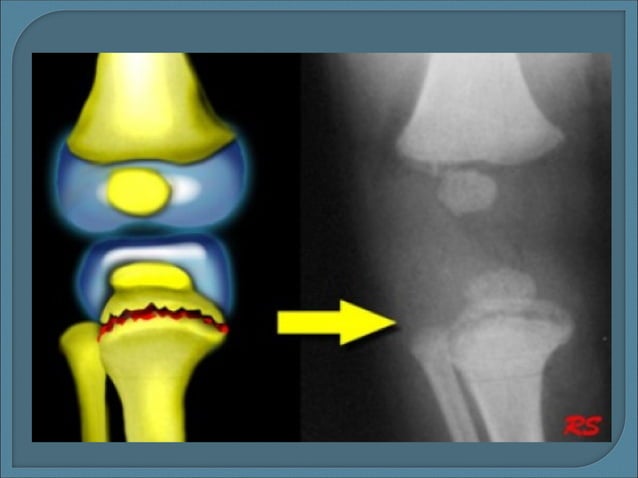 Childhood fractures | PPT