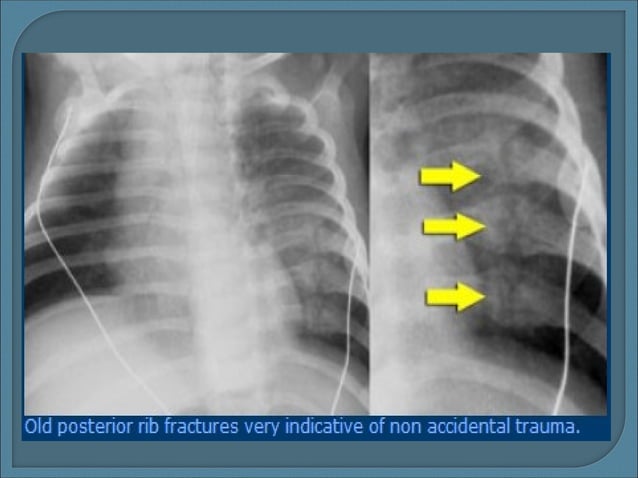 Childhood fractures | PPT