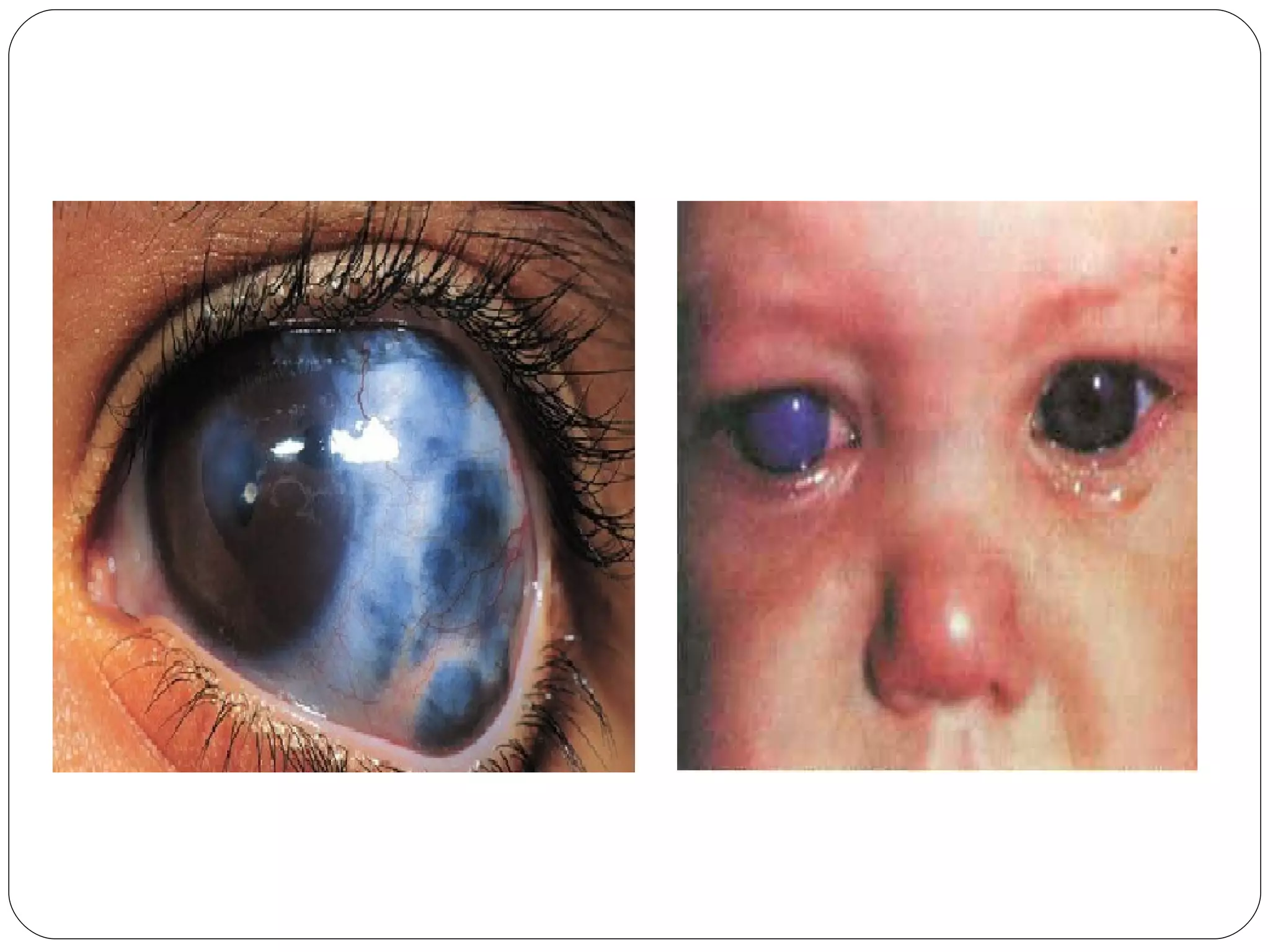 Childhood glaucoma | PPT