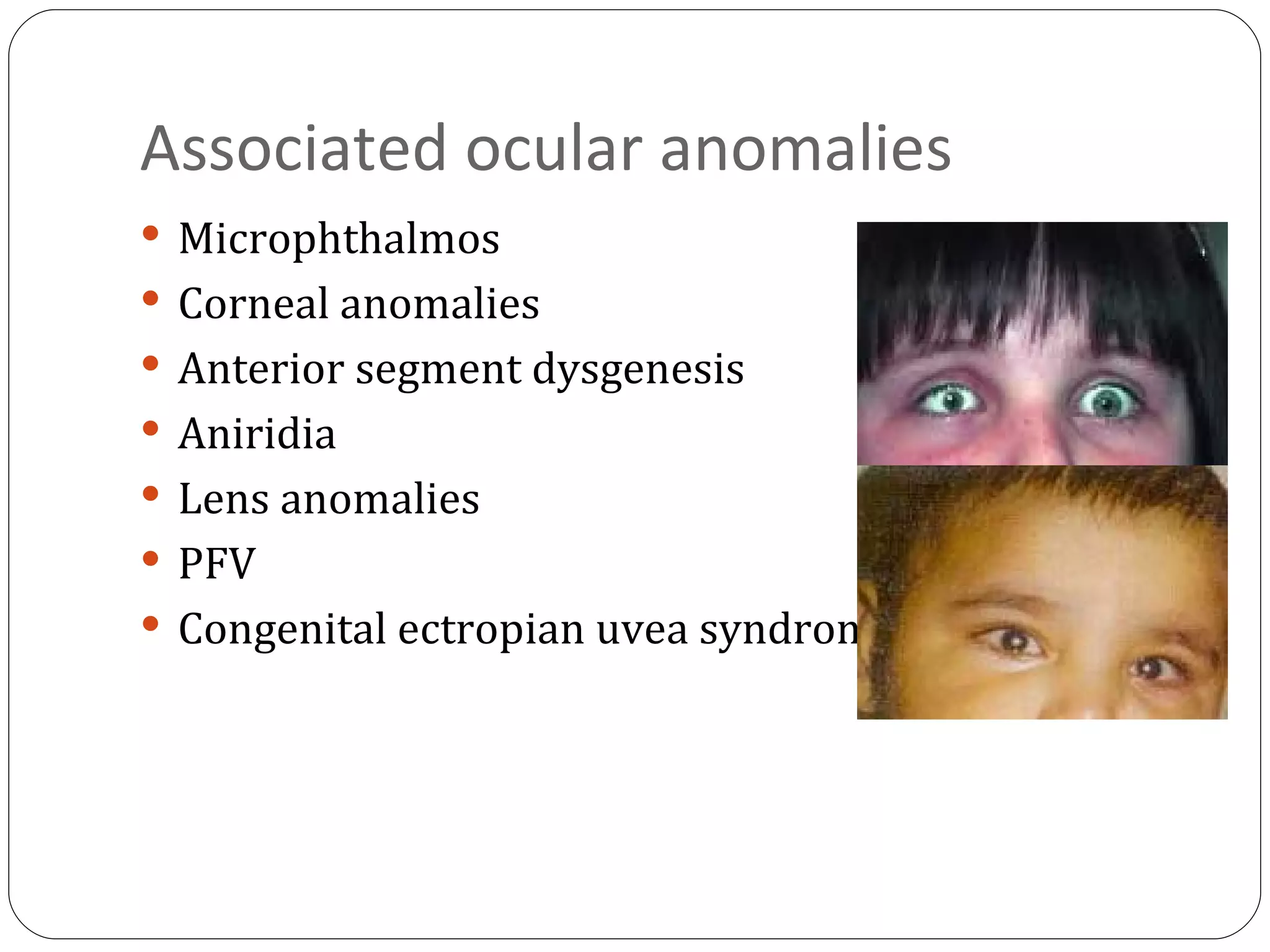 Childhood glaucoma | PPT