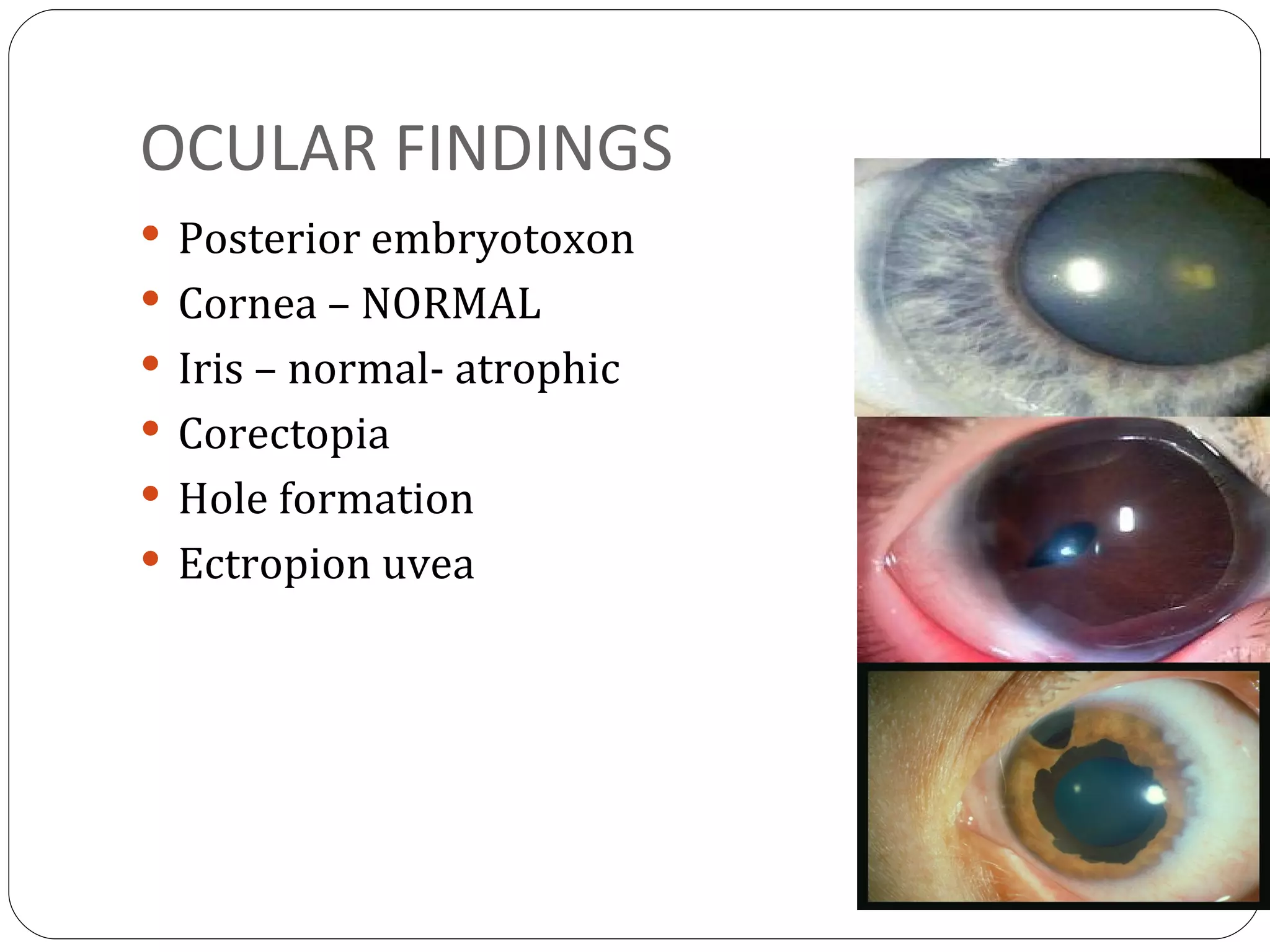 Childhood glaucoma | PPT
