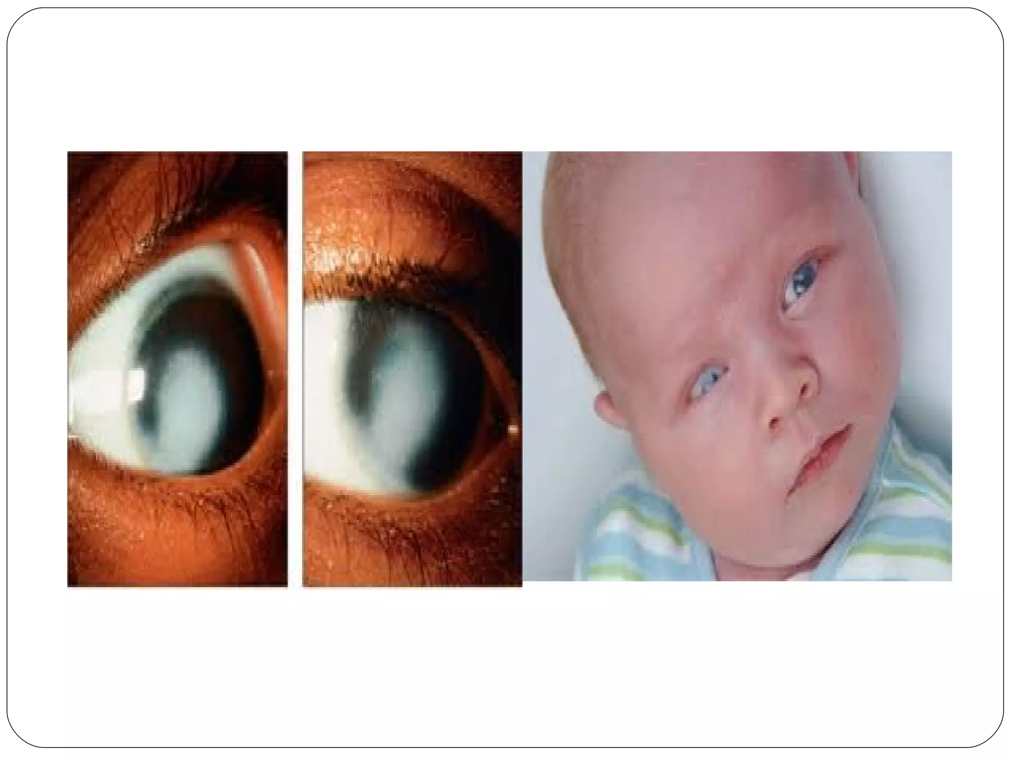 Childhood glaucoma | PPT