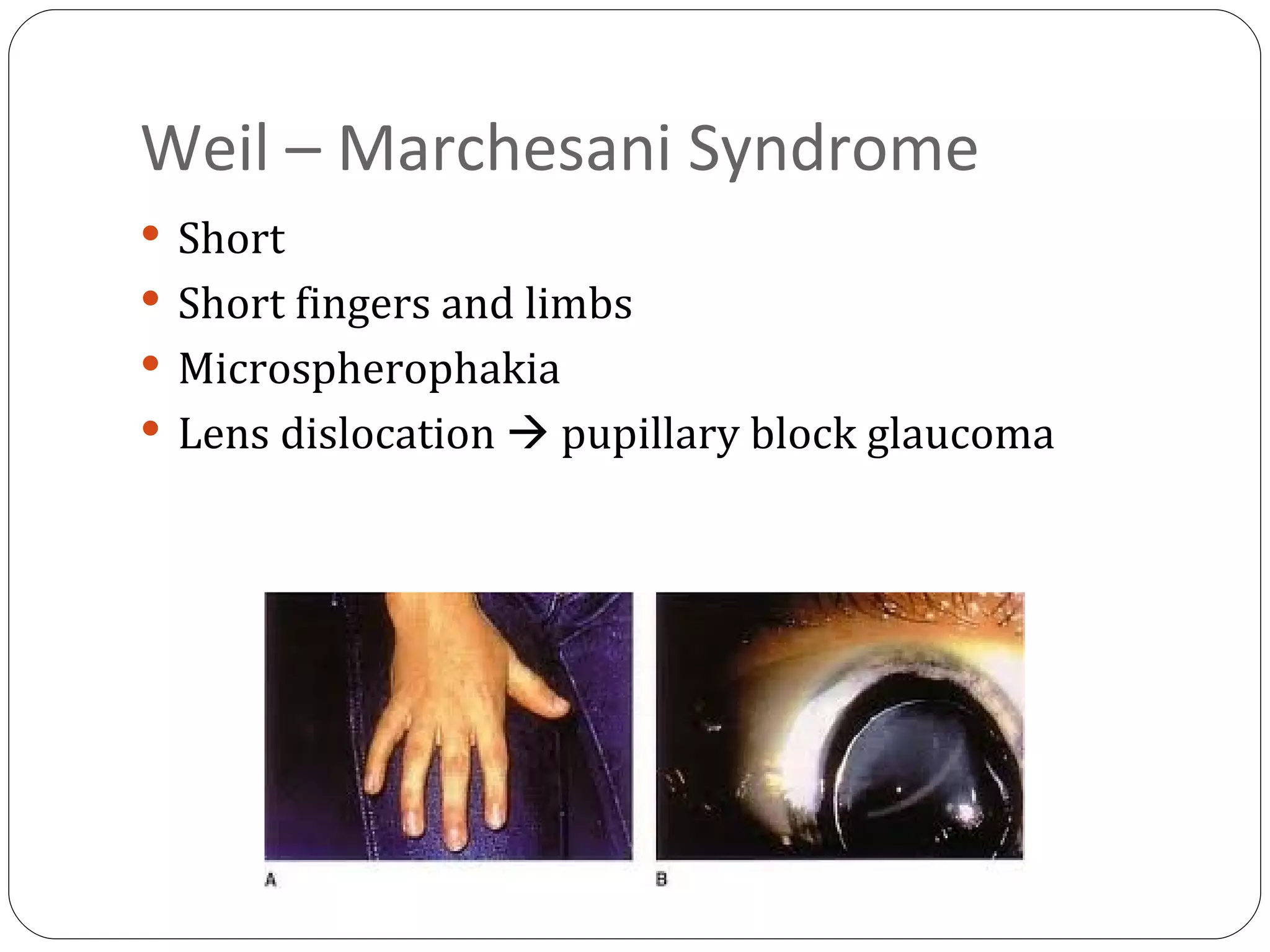 Childhood glaucoma | PPT