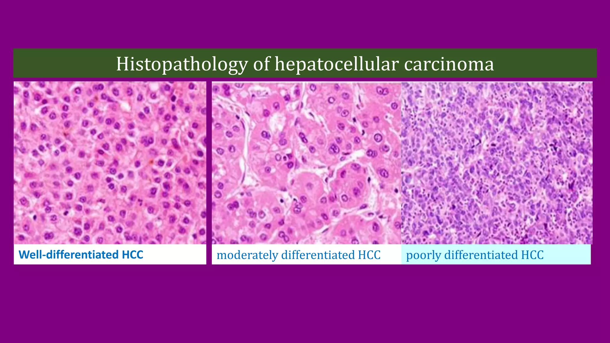 Childhood hepatocellular carcinoma.pdf