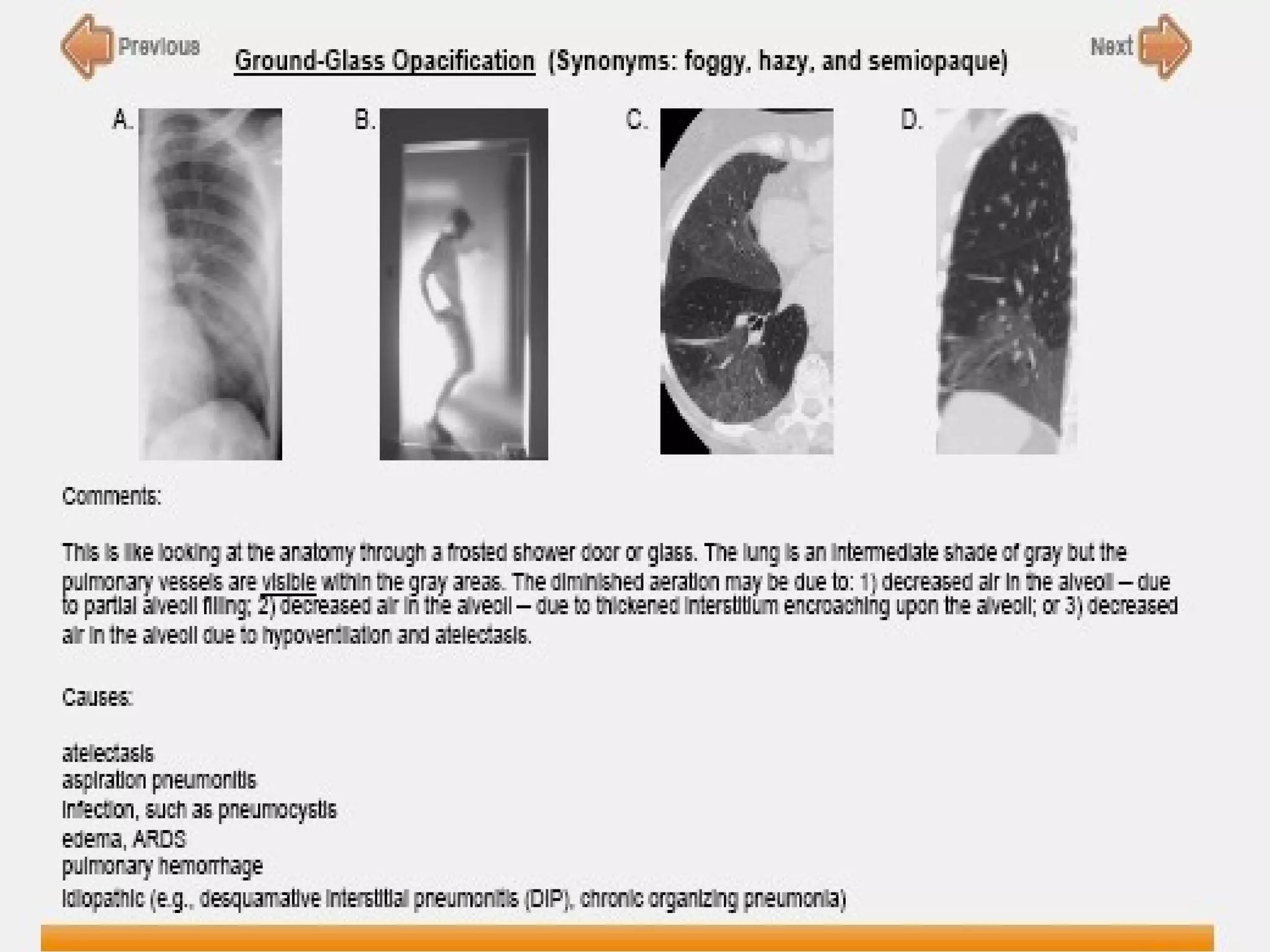 Childhood interstitial lung disease | PPT
