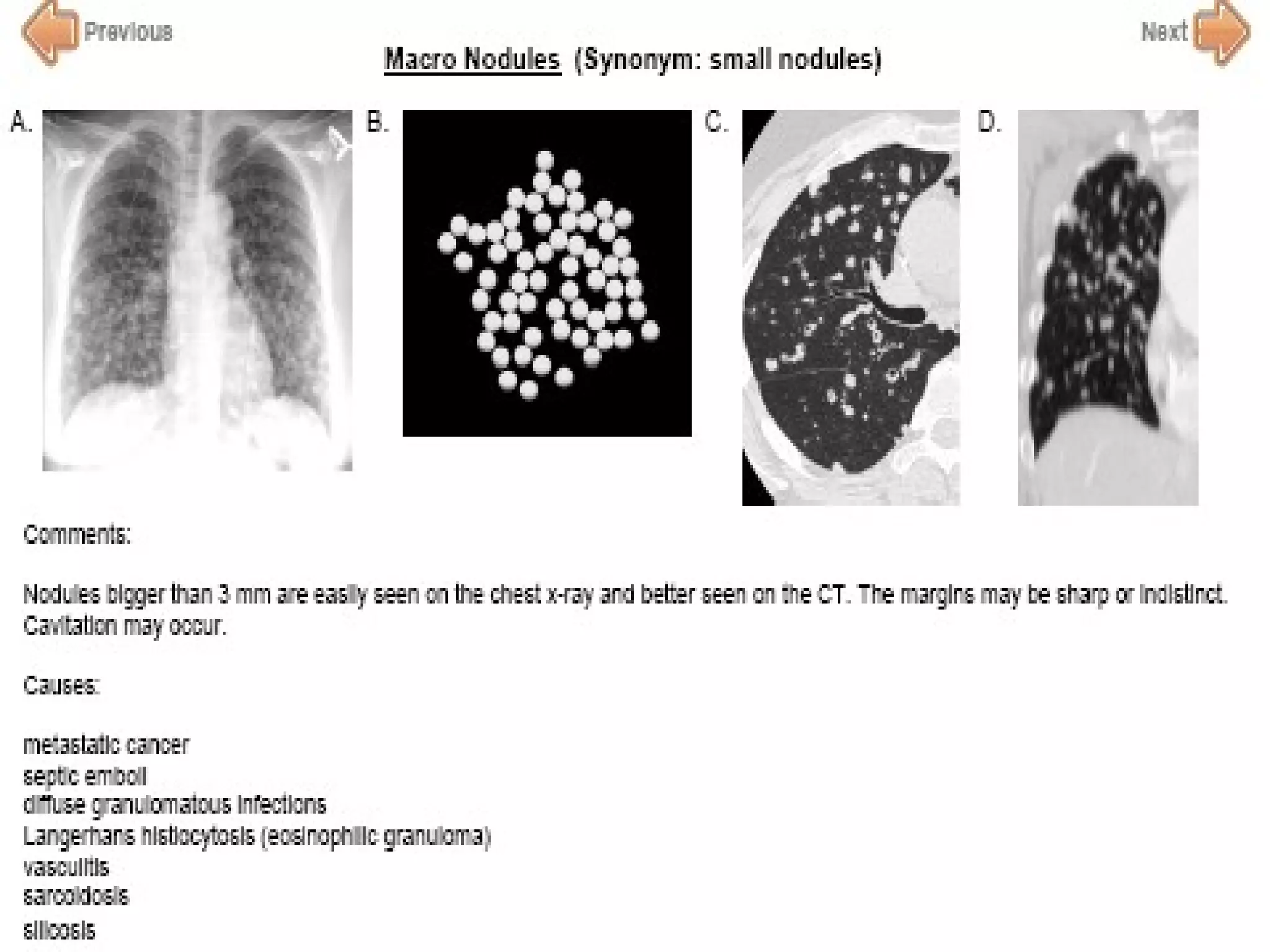 Childhood interstitial lung disease | PPT