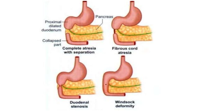 childhood intestinal obstruction.pptx