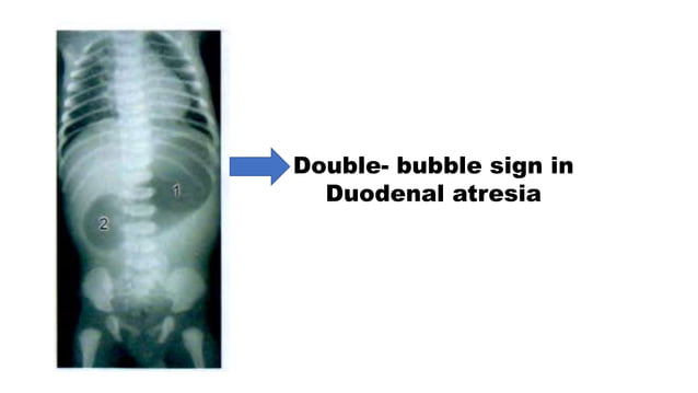 childhood intestinal obstruction.pptx
