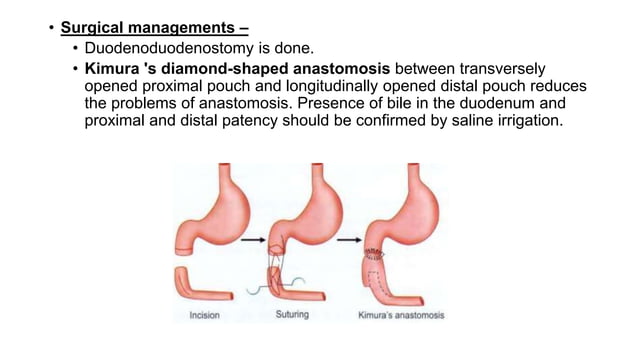 childhood intestinal obstruction.pptx
