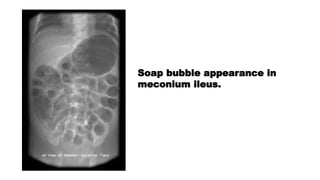 childhood intestinal obstruction.pptx | Pregnancy | Reproductive Health