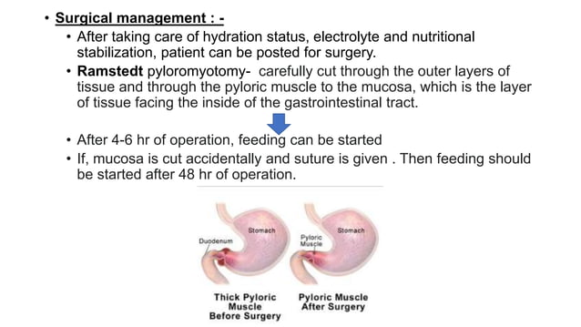 childhood intestinal obstruction.pptx